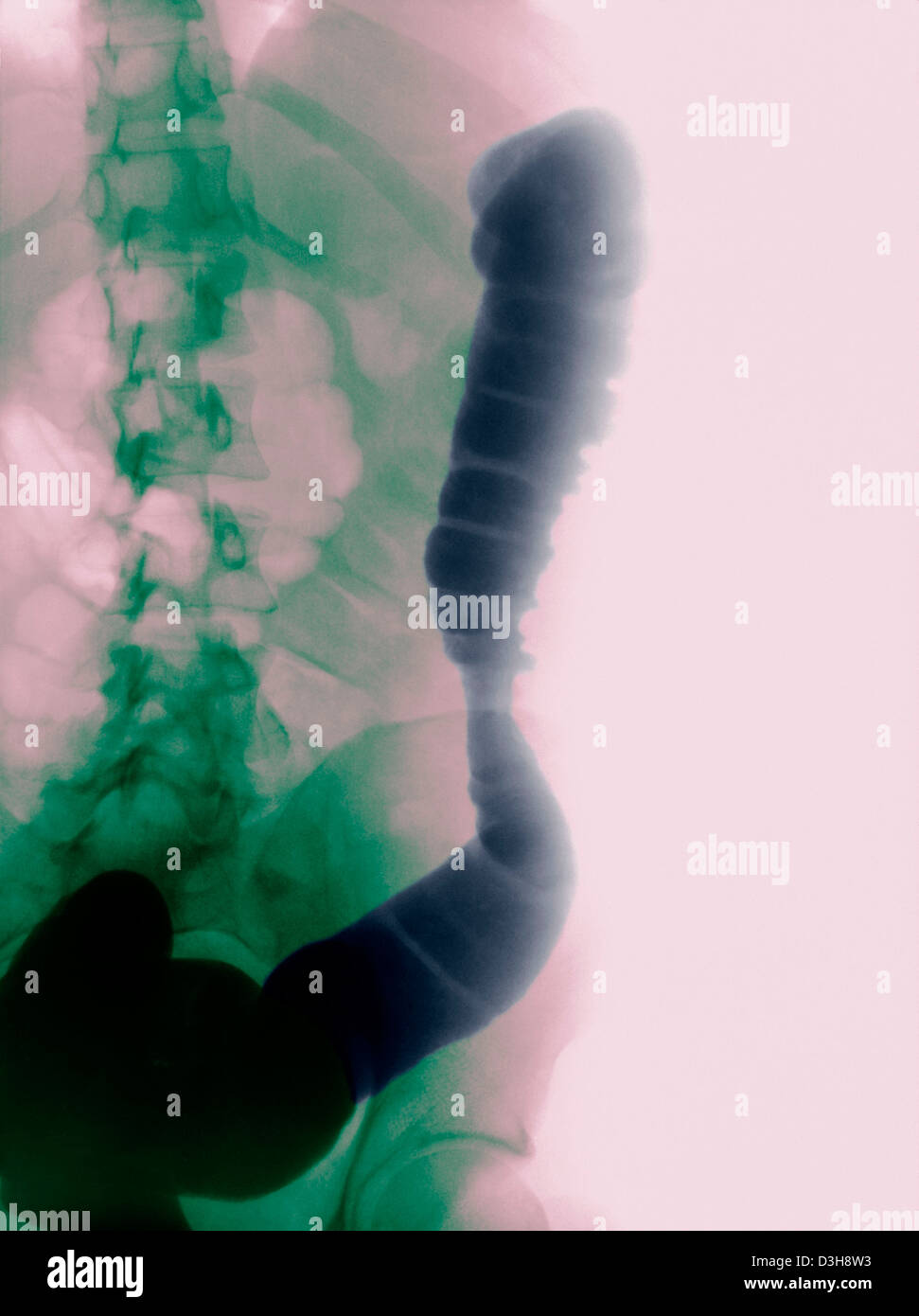 COLITIS, X-RAY Stock Photo - Alamy