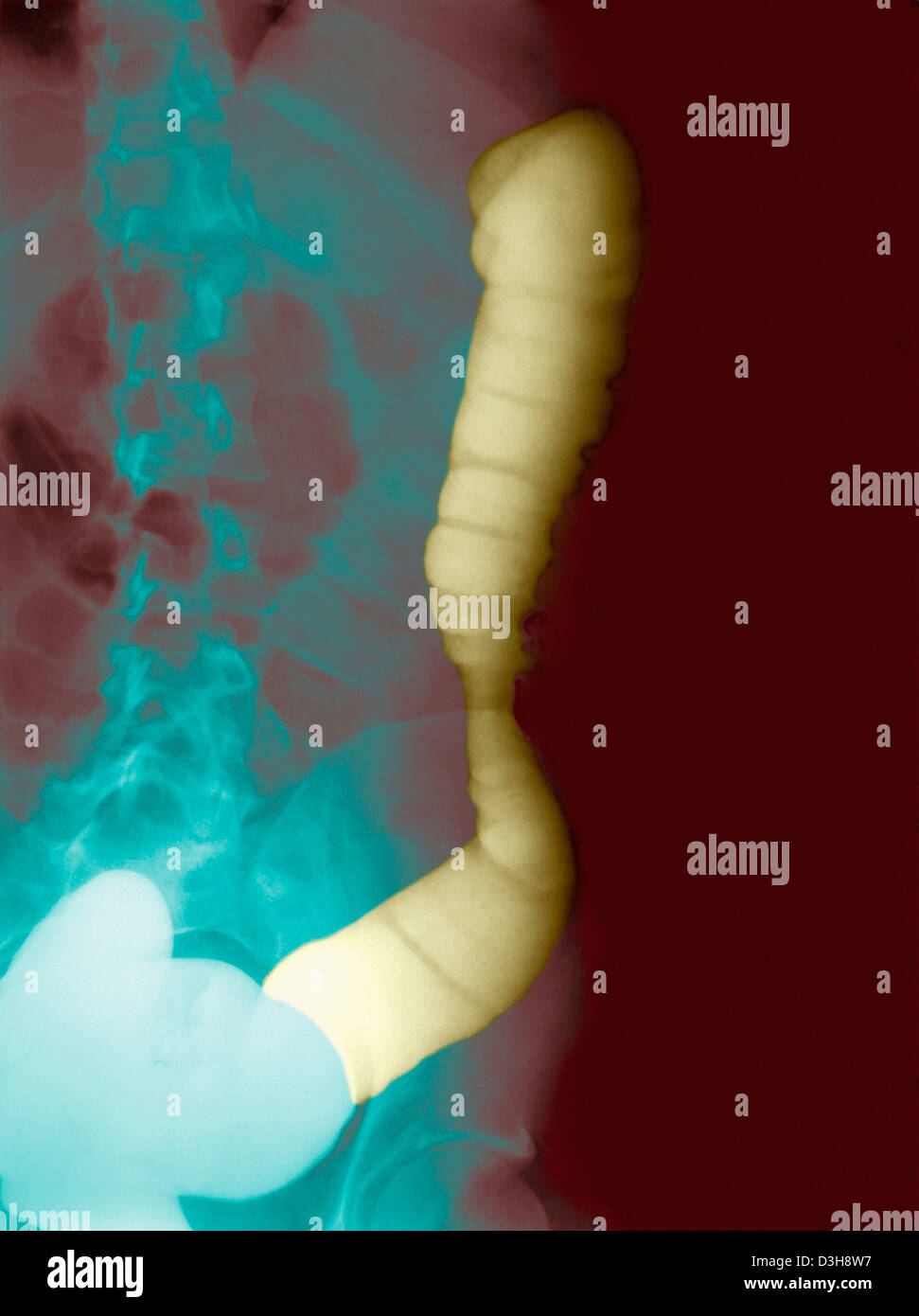 Intestine digestive tract photos hi-res stock photography and images ...