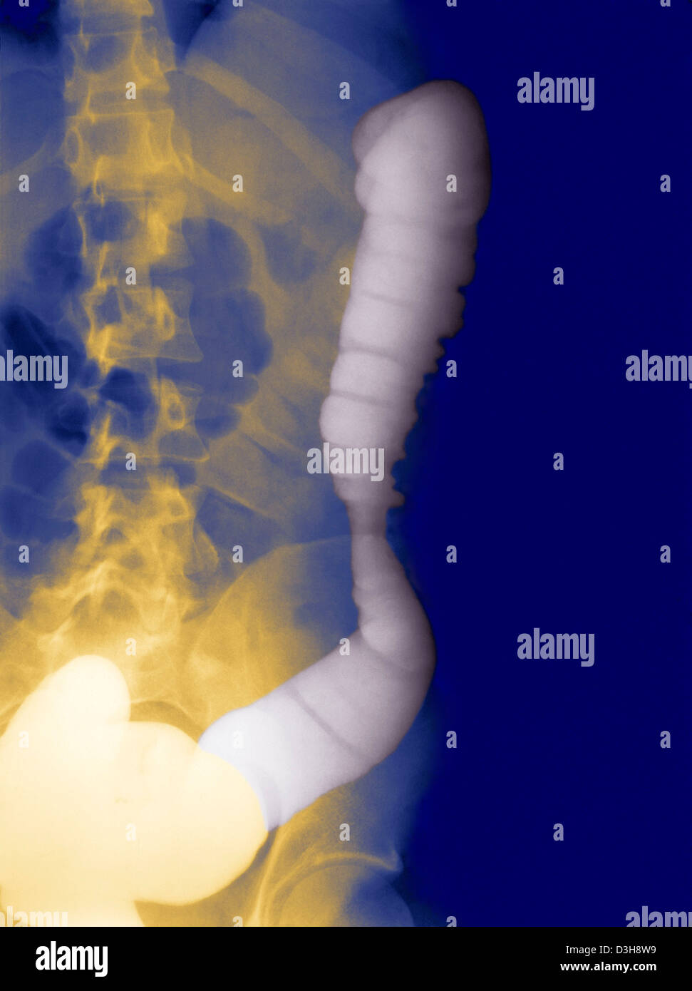 Intestine digestive tract photos hi-res stock photography and images ...