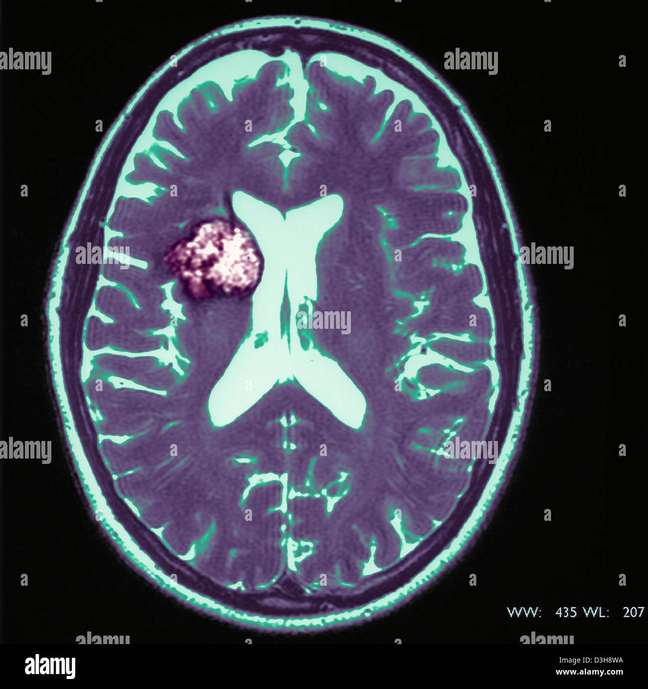CEREBRAL CAVERNOUS ANGIOMA Stock Photo - Alamy
