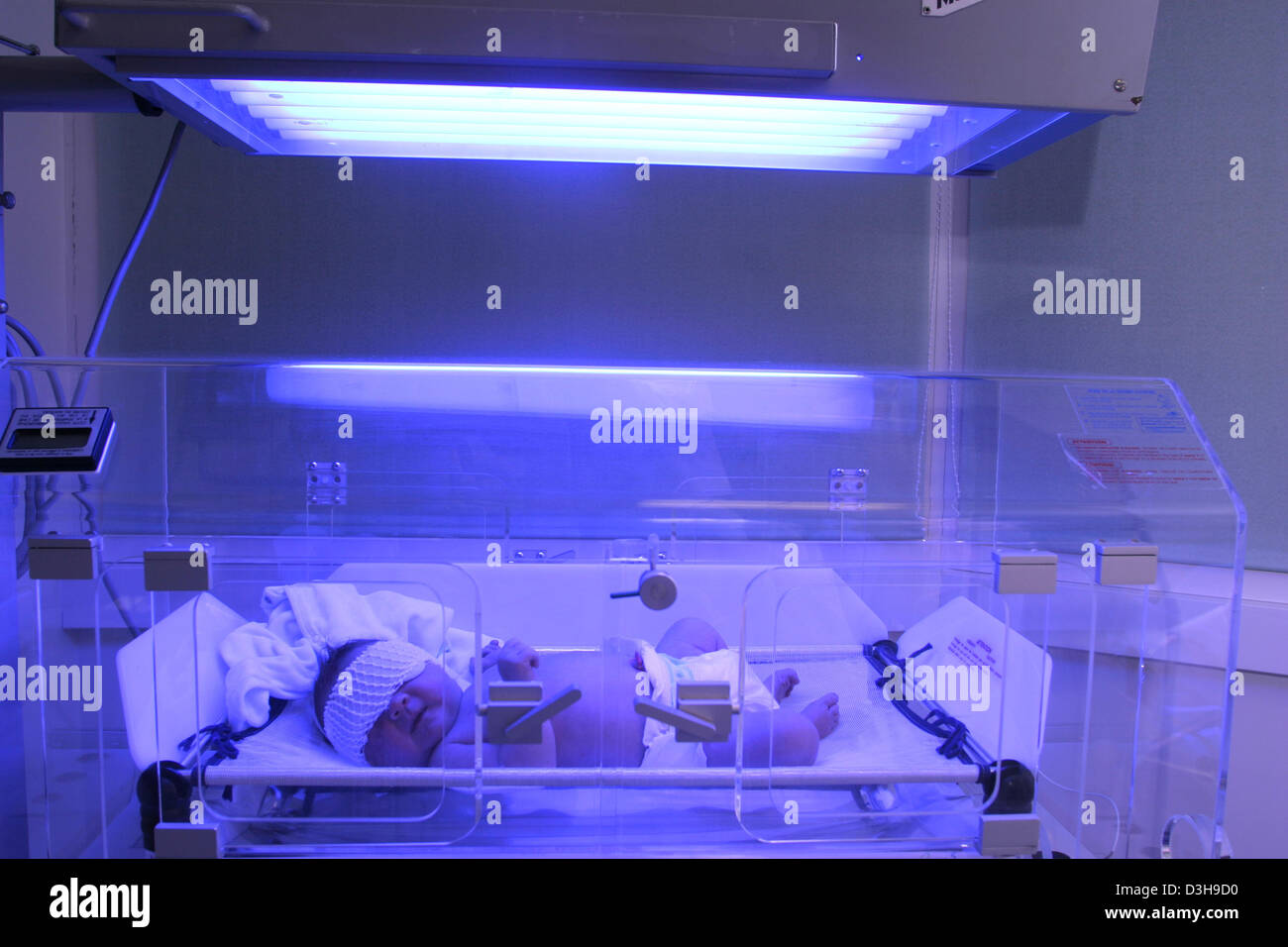 NEONATAL JAUNDICE, PHOTOTHERAPY Stock Photo - Alamy