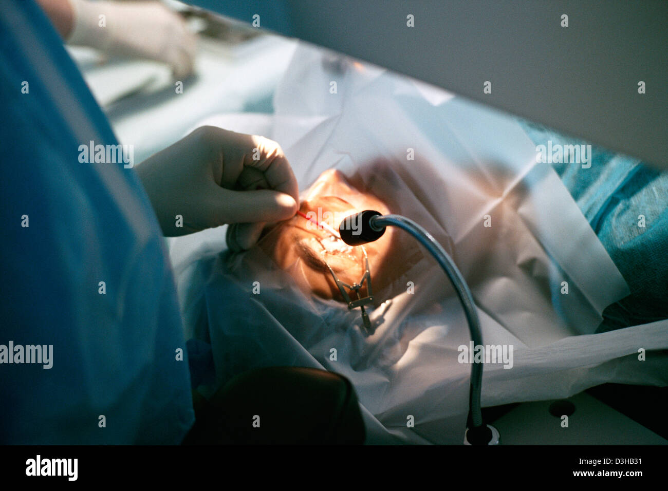 EYE LASER SURGERY Stock Photo - Alamy