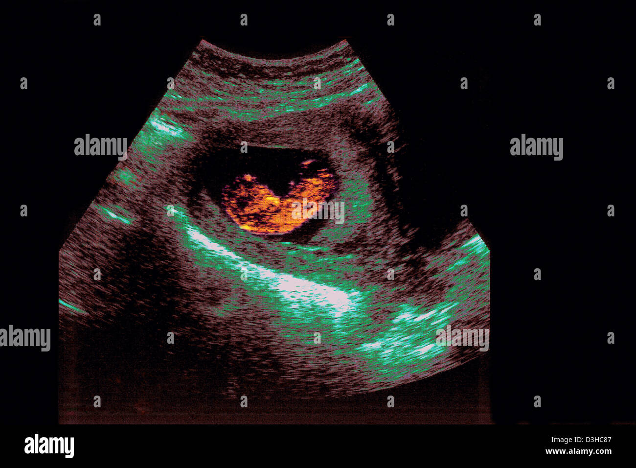 ULTRASOUND BIOMETRY OF THE FETUS Stock Photo - Alamy