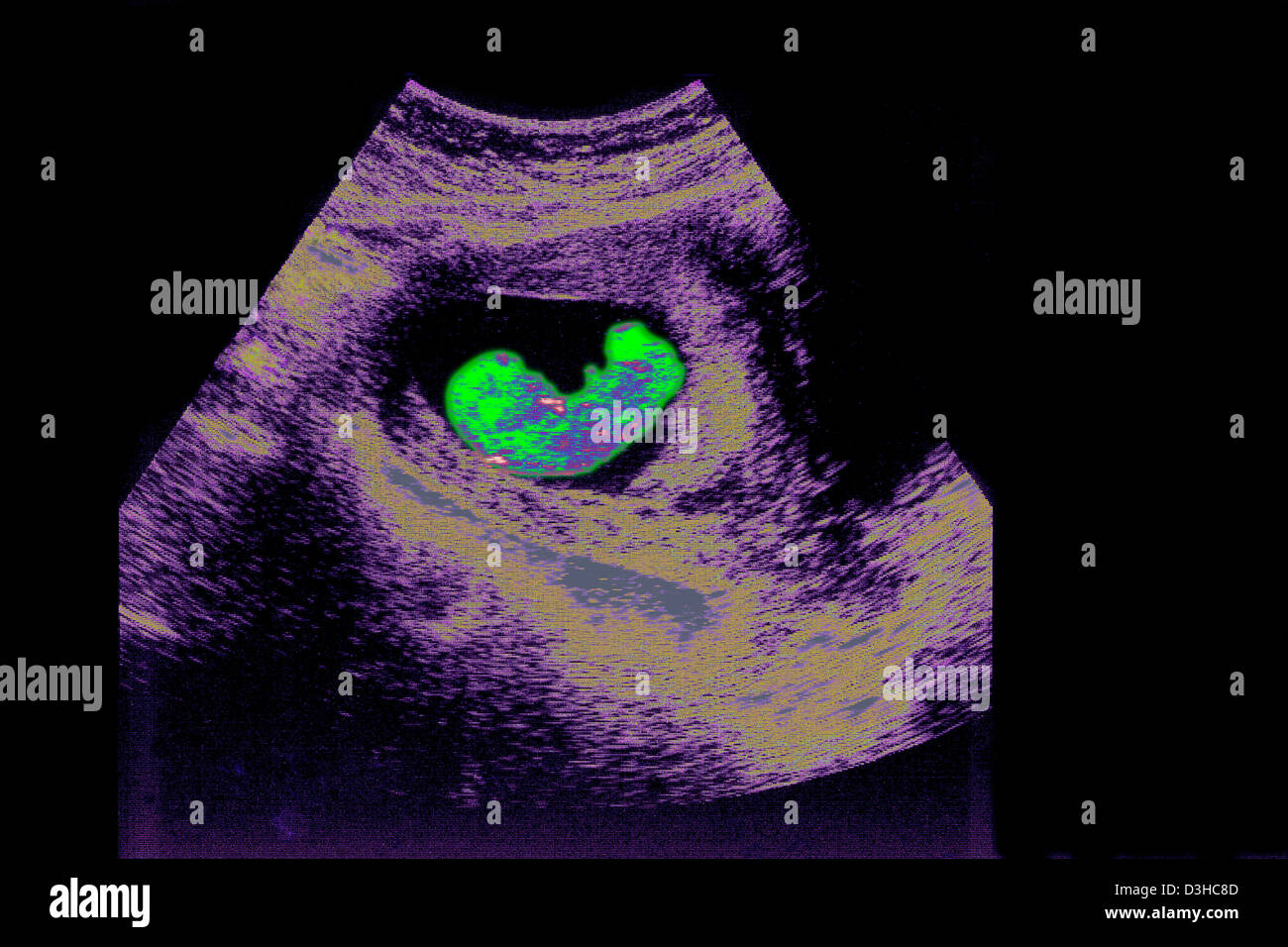 ULTRASOUND BIOMETRY OF THE FETUS Stock Photo - Alamy
