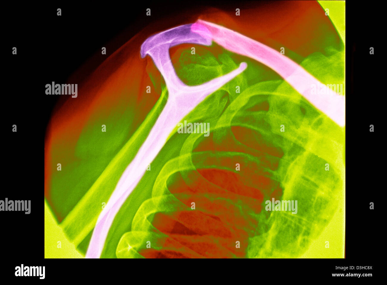 Collarbone x ray hi-res stock photography and images - Alamy
