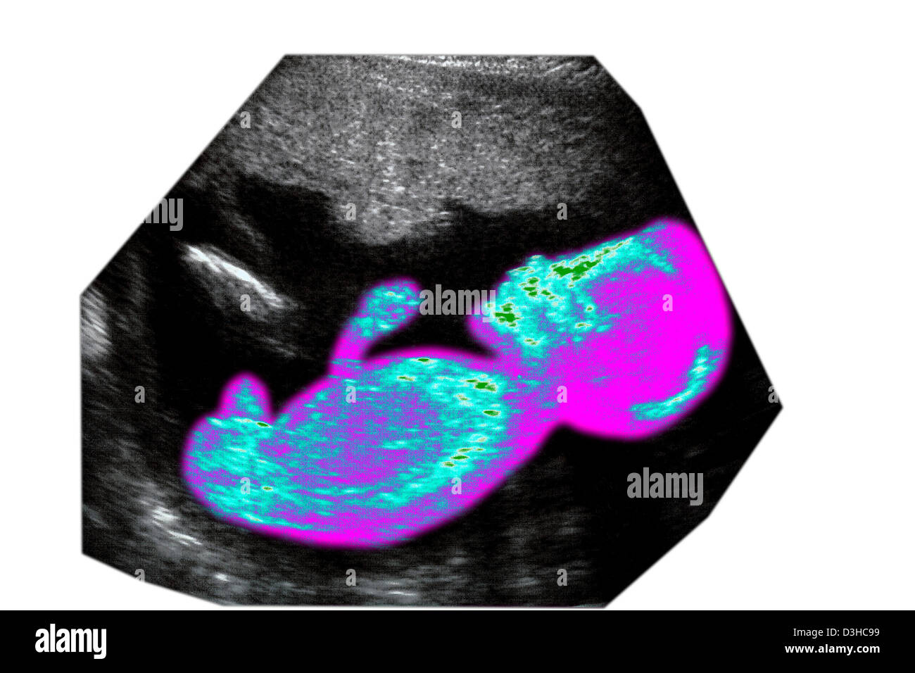 ULTRASOUND BIOMETRY OF THE FETUS Stock Photo - Alamy
