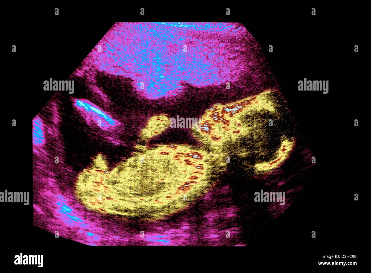 ULTRASOUND BIOMETRY OF THE FETUS Stock Photo - Alamy