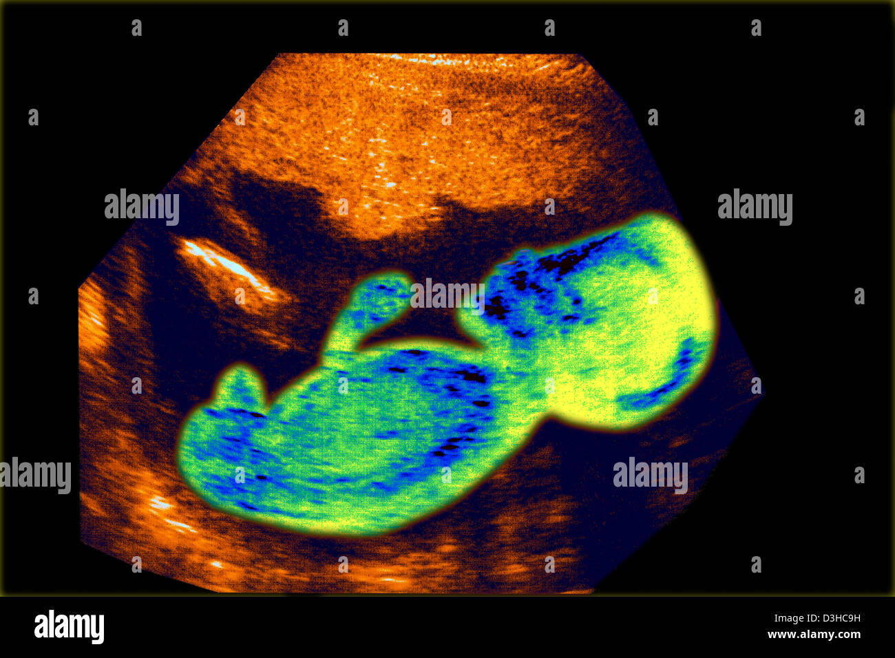ULTRASOUND BIOMETRY OF THE FETUS Stock Photo - Alamy