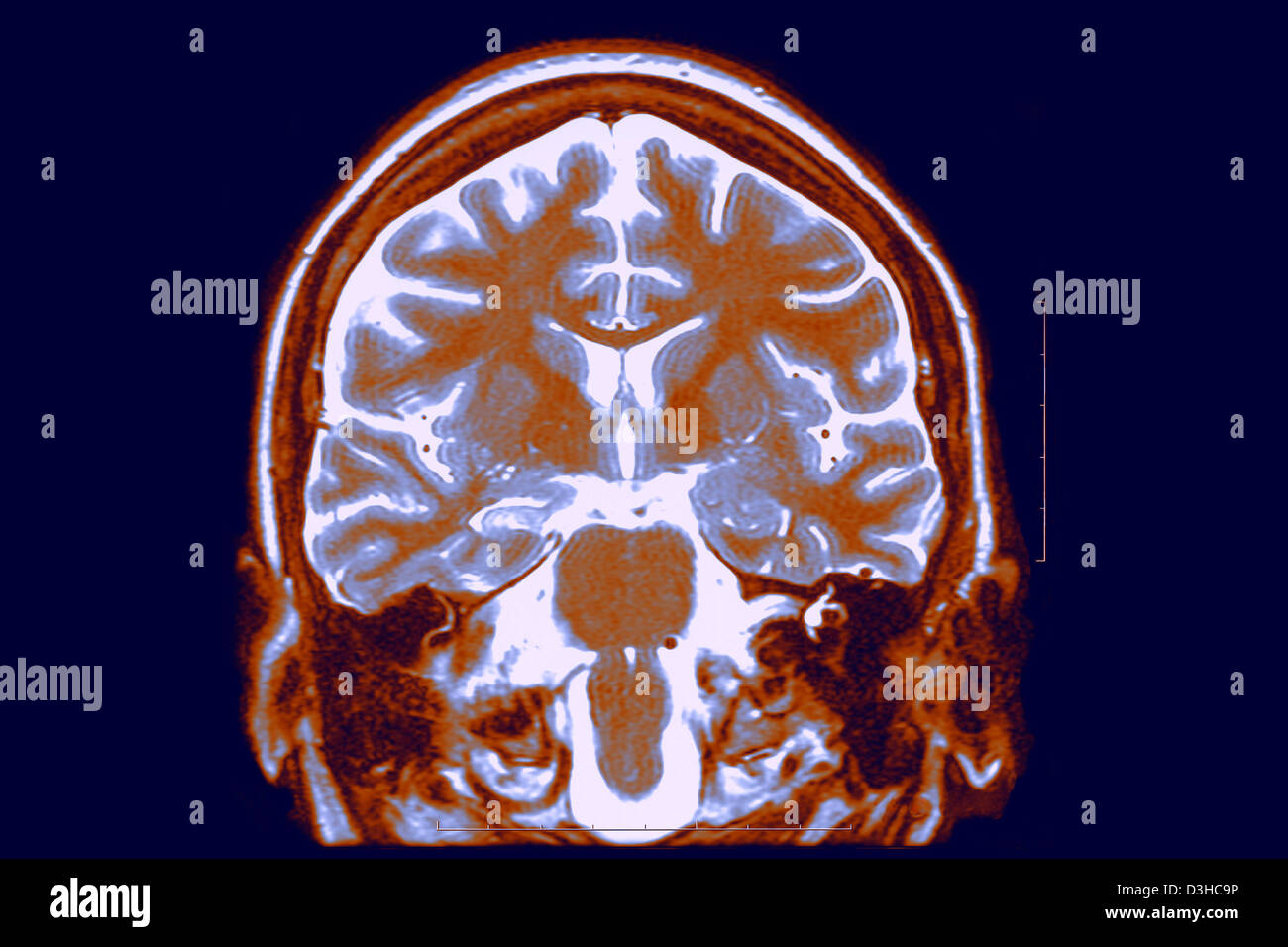 Brain mri hippocampus hi-res stock photography and images - Alamy