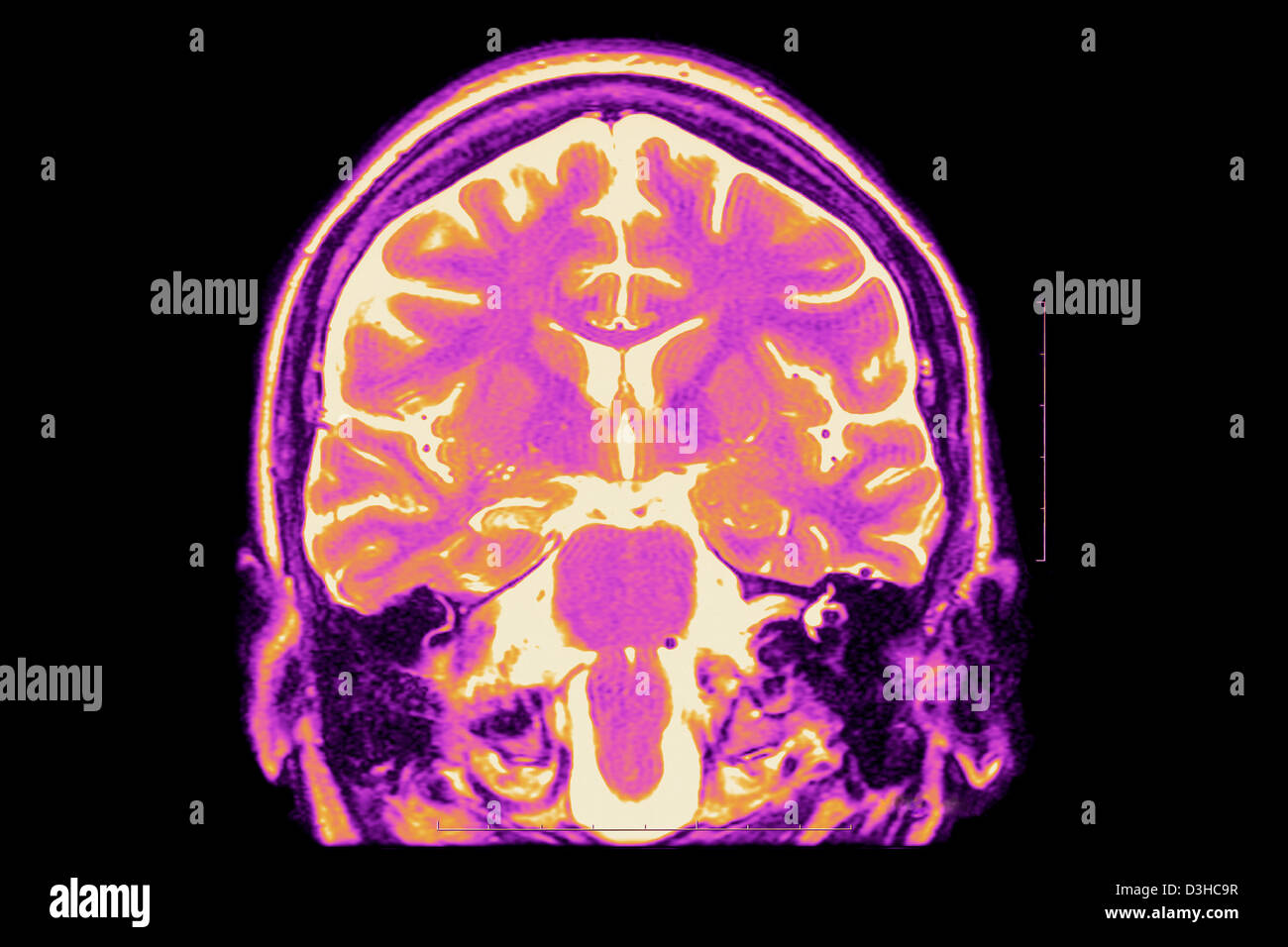 Epilepsy brain scan hi-res stock photography and images - Alamy