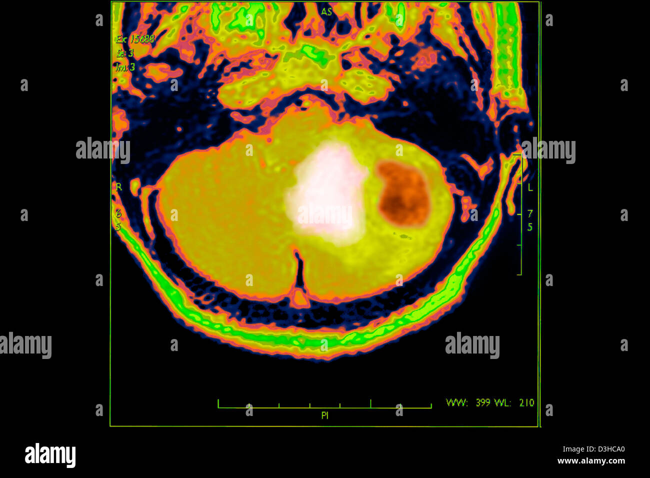 Fluid attenuated inversion recovery hi-res stock photography and images ...