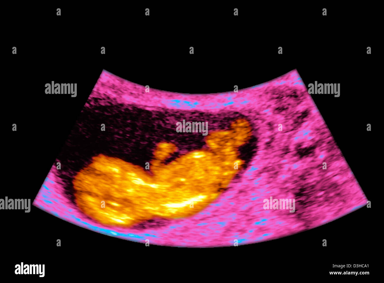12 weeks fetus hi-res stock photography and images - Alamy