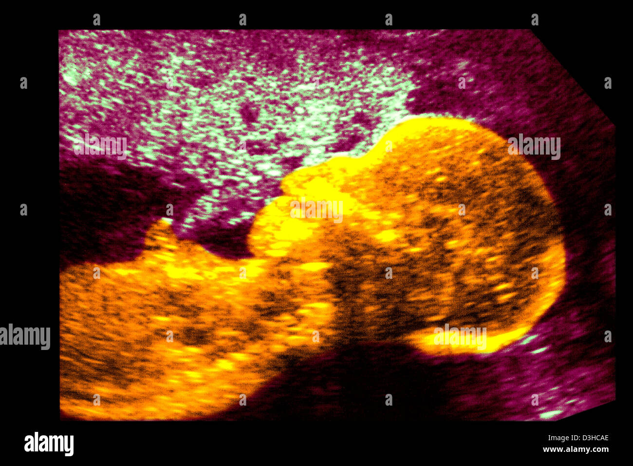 5 month fetus hi-res stock photography and images - Alamy
