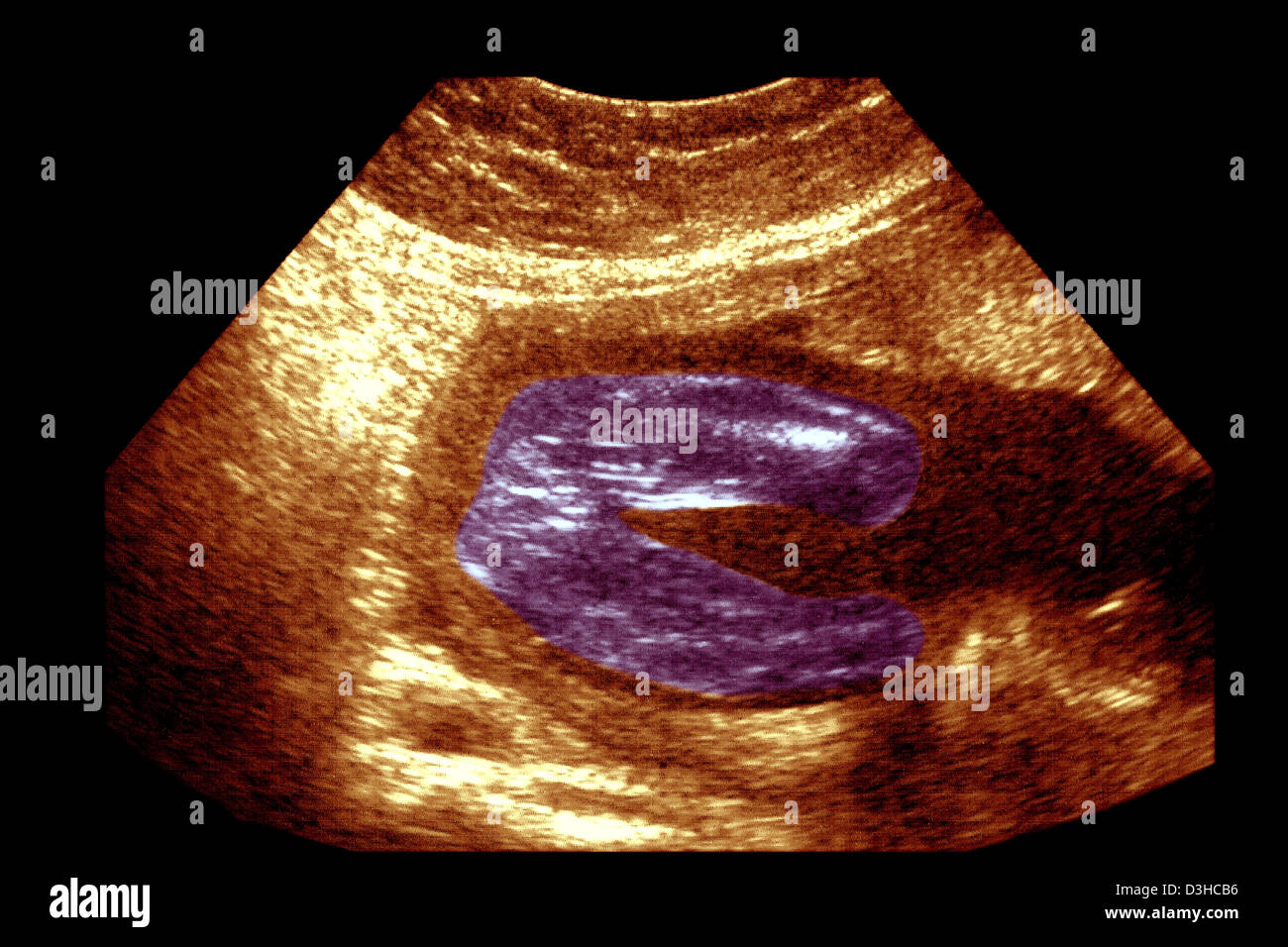 ULTRASOUND BIOMETRY OF THE FETUS Stock Photo - Alamy