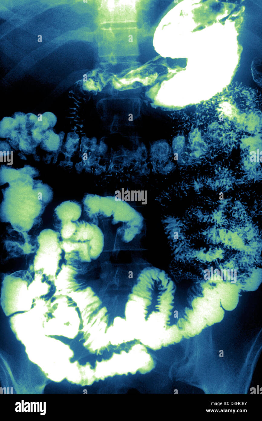 SMALL INTESTINE, X-RAY Stock Photo - Alamy