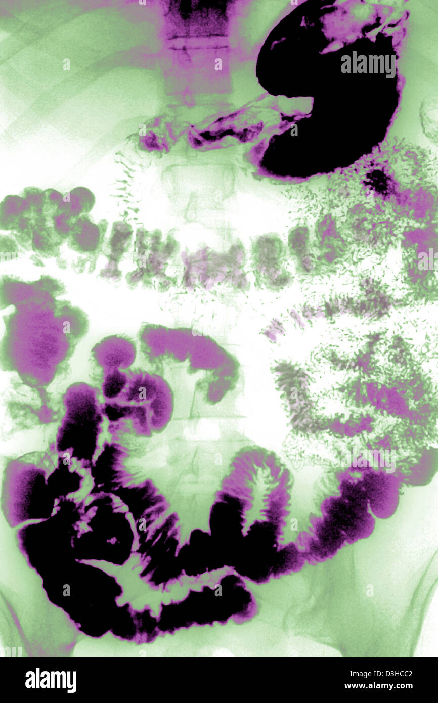 SMALL INTESTINE, X-RAY Stock Photo - Alamy