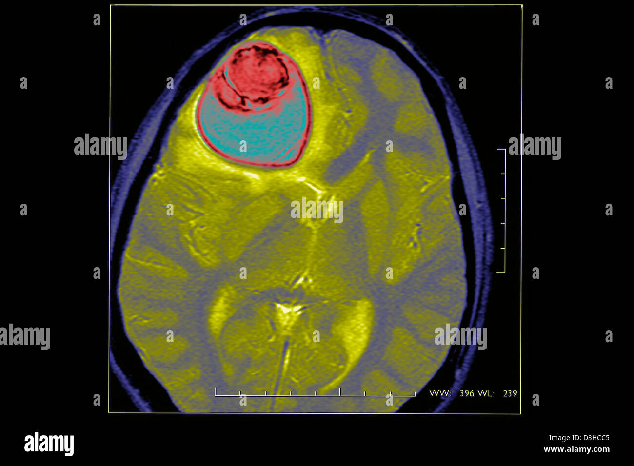 Benign brain mri hi-res stock photography and images - Alamy