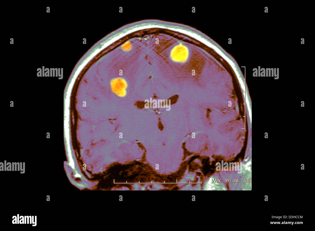 METASTASIS IN THE BRAIN, MRI Stock Photo - Alamy