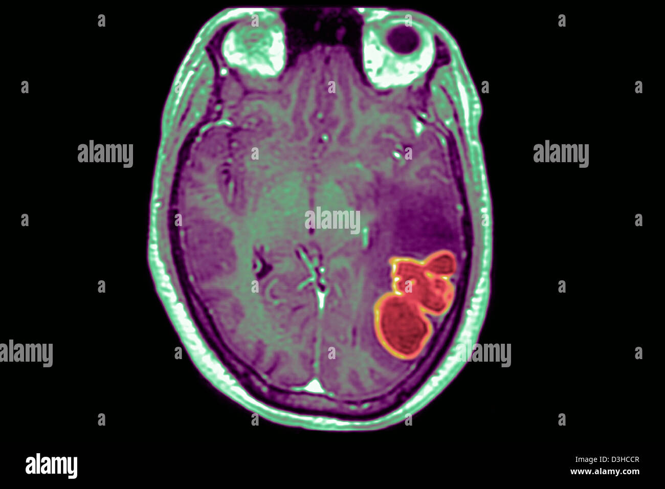 Brain abscesses hi-res stock photography and images - Alamy