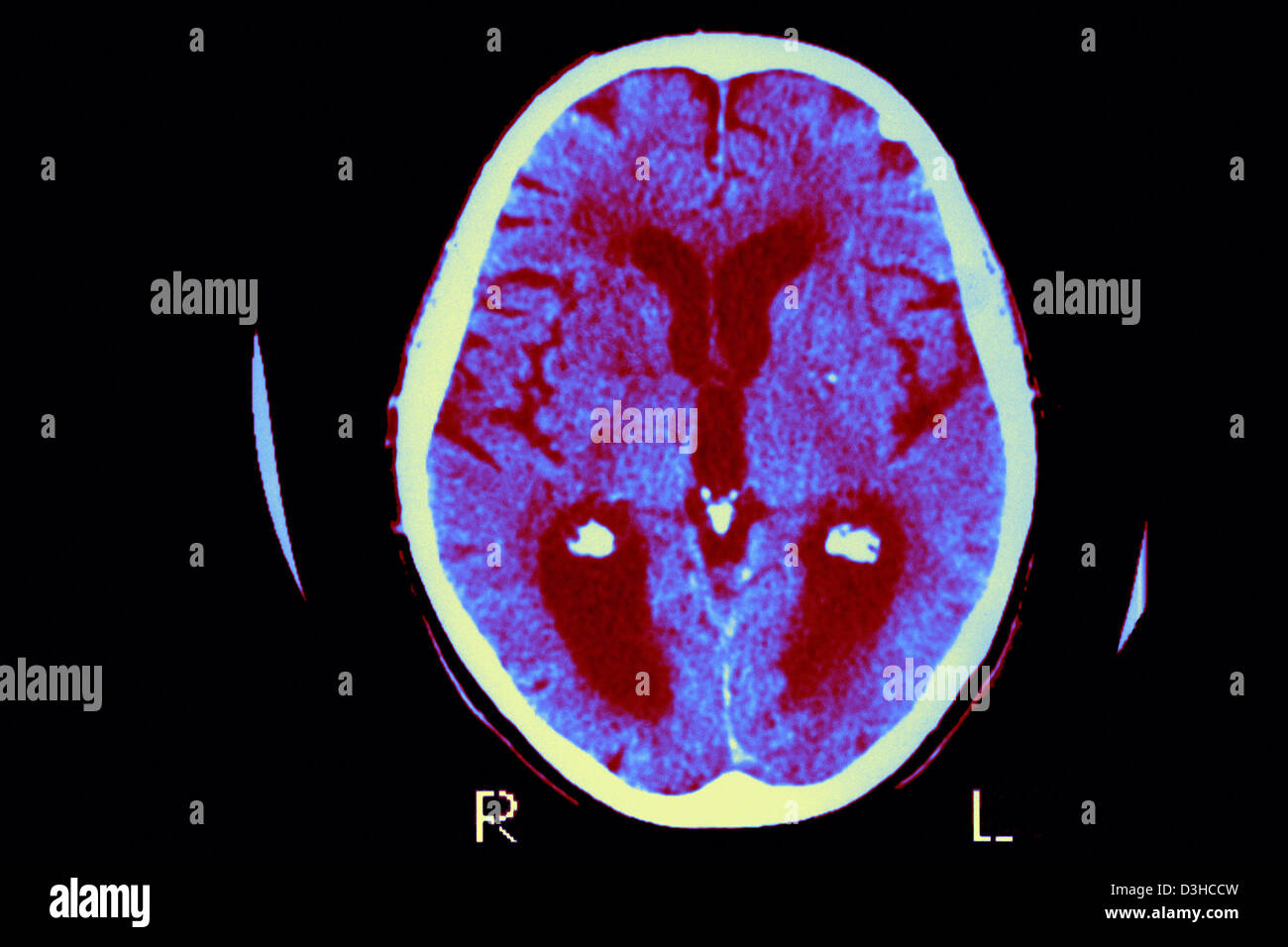 ALZHEIMER'S DISEASE, SCAN Stock Photo - Alamy