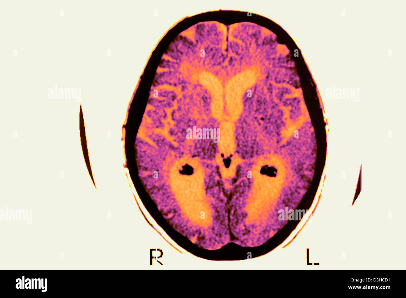 Dementia brain scan hi-res stock photography and images - Alamy