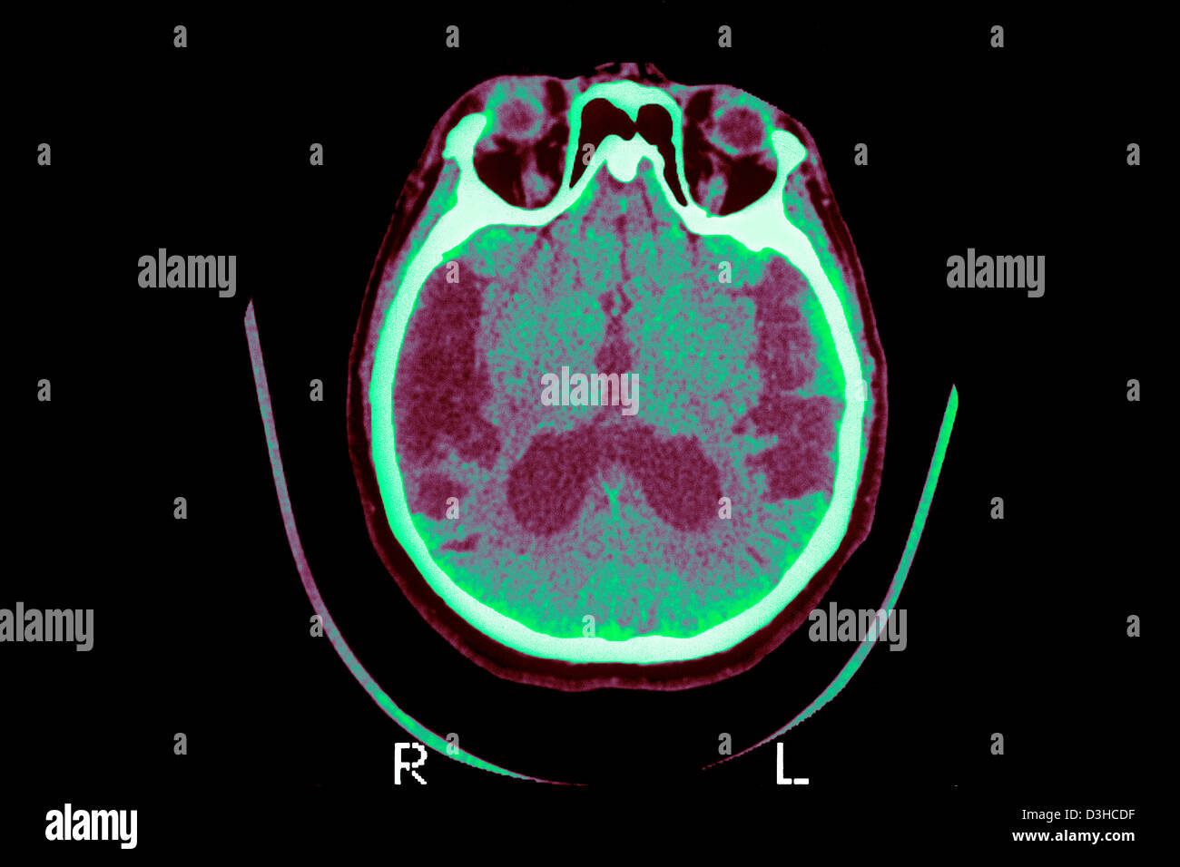 ALZHEIMER'S DISEASE, SCAN Stock Photo - Alamy