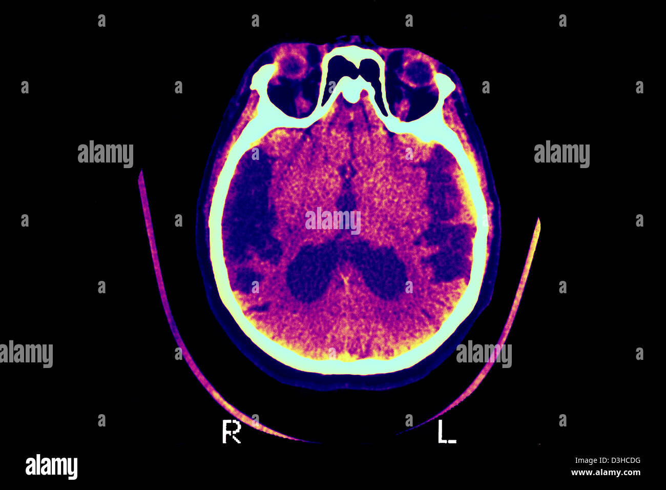 Alzheimers brain scan hi-res stock photography and images - Alamy