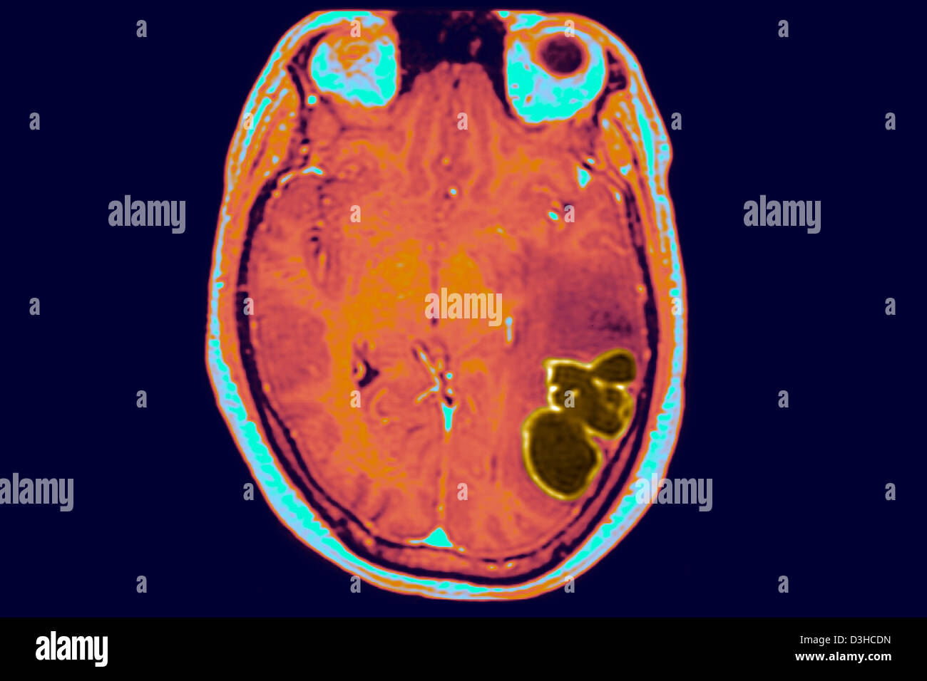 Brain abscesses hi-res stock photography and images - Alamy