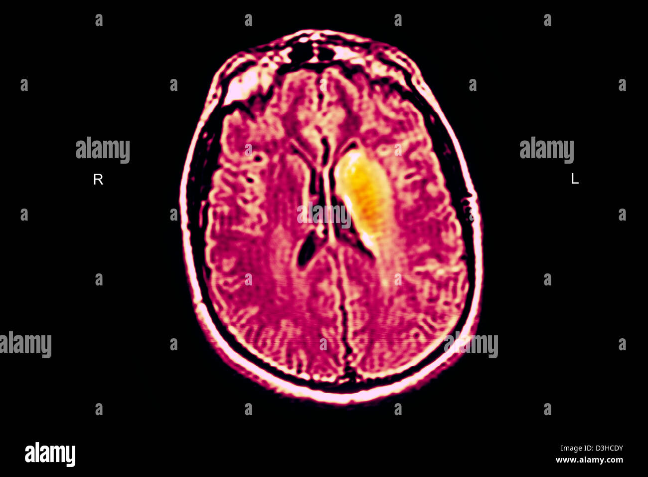 Cerebral vascular accidents hi-res stock photography and images - Alamy