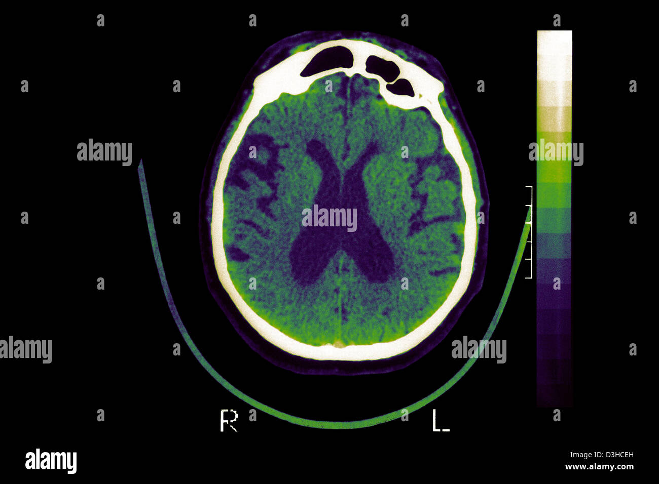 ALZHEIMER'S DISEASE, SCAN Stock Photo - Alamy
