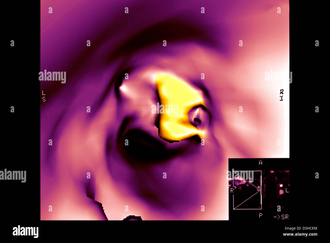 Atheroma carotid artery hi-res stock photography and images - Alamy