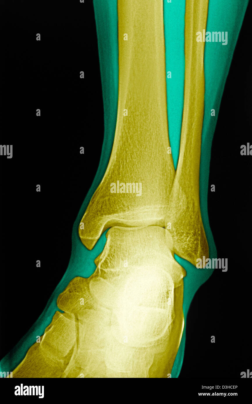 Normal ankle joint x ray hi-res stock photography and images - Alamy