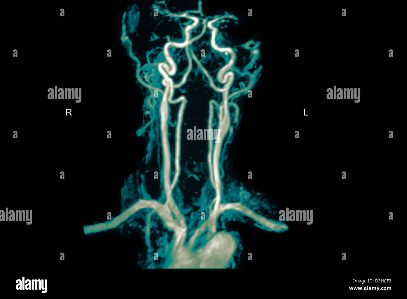 Mri neck normal hi-res stock photography and images - Alamy