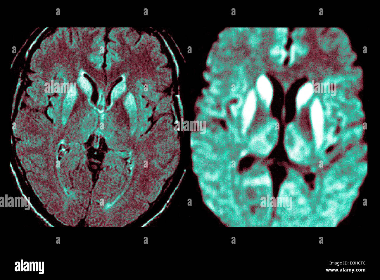 CREUTZFELDT JAKOB DISEASE, MRI Stock Photo - Alamy