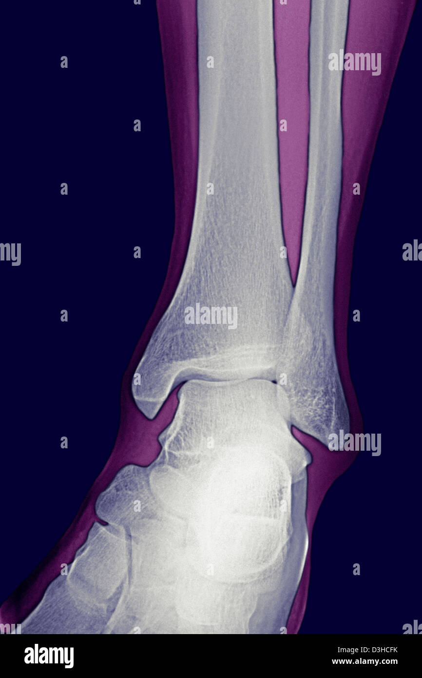 Normal ankle joint x ray hi-res stock photography and images - Alamy