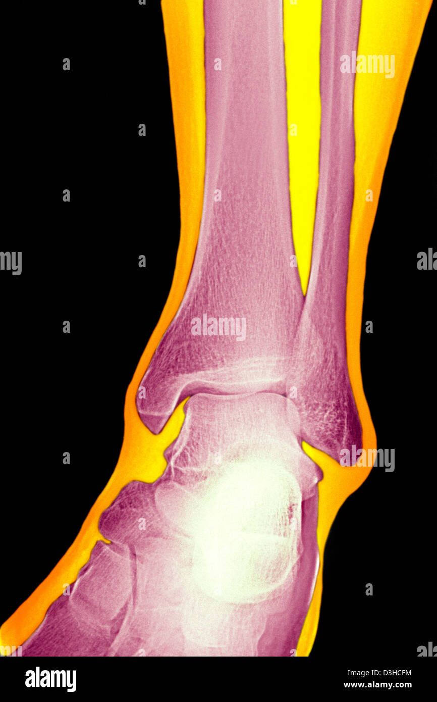 Normal Ankle Joint X Ray High Resolution Stock Photography and Images ...