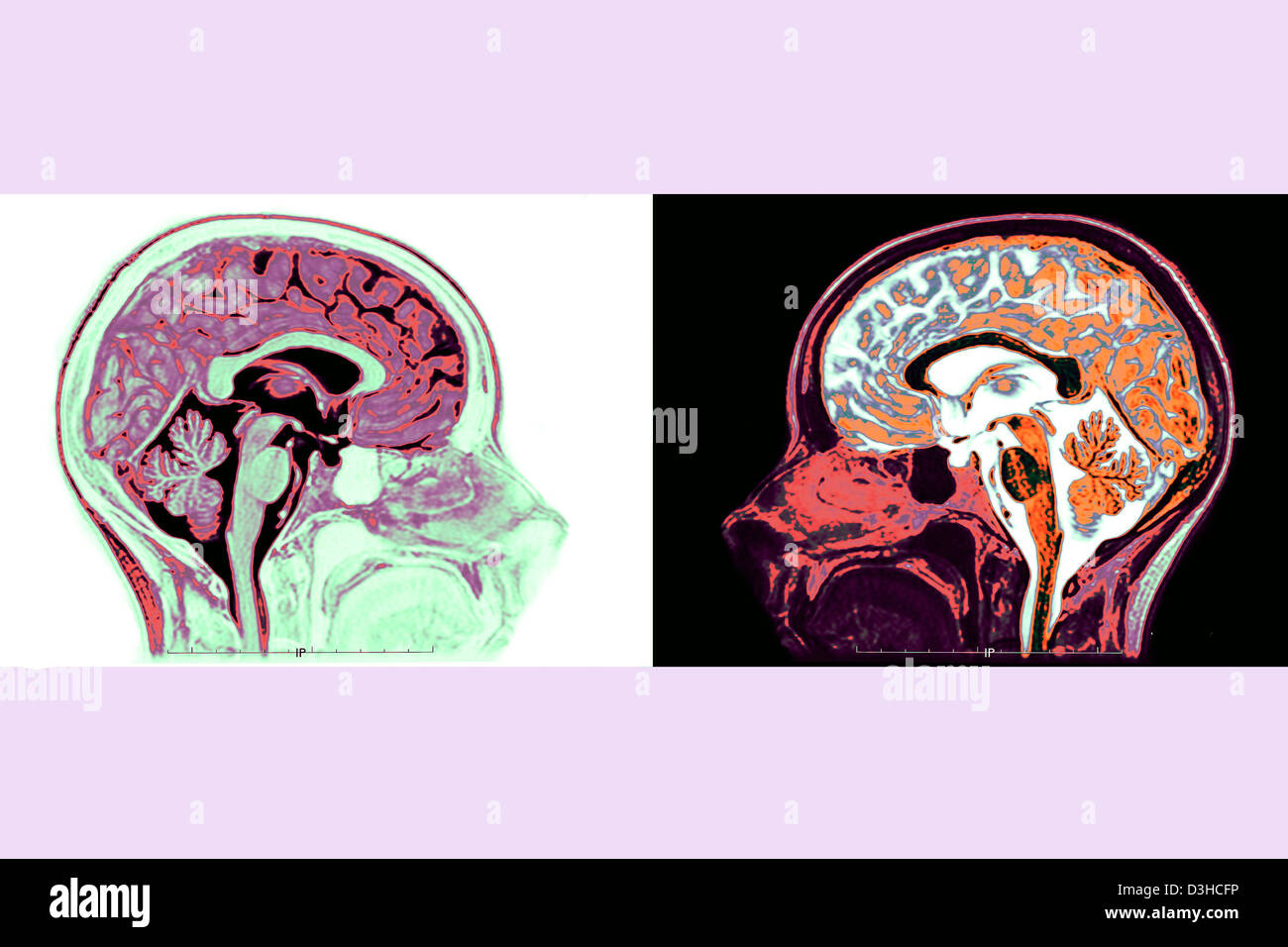 Nmr brain scan hi-res stock photography and images - Alamy