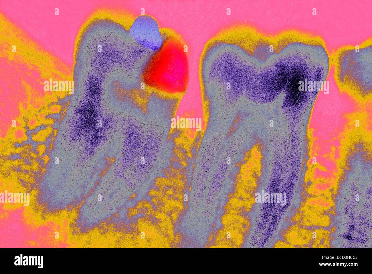Tooth decay x ray hi-res stock photography and images - Alamy