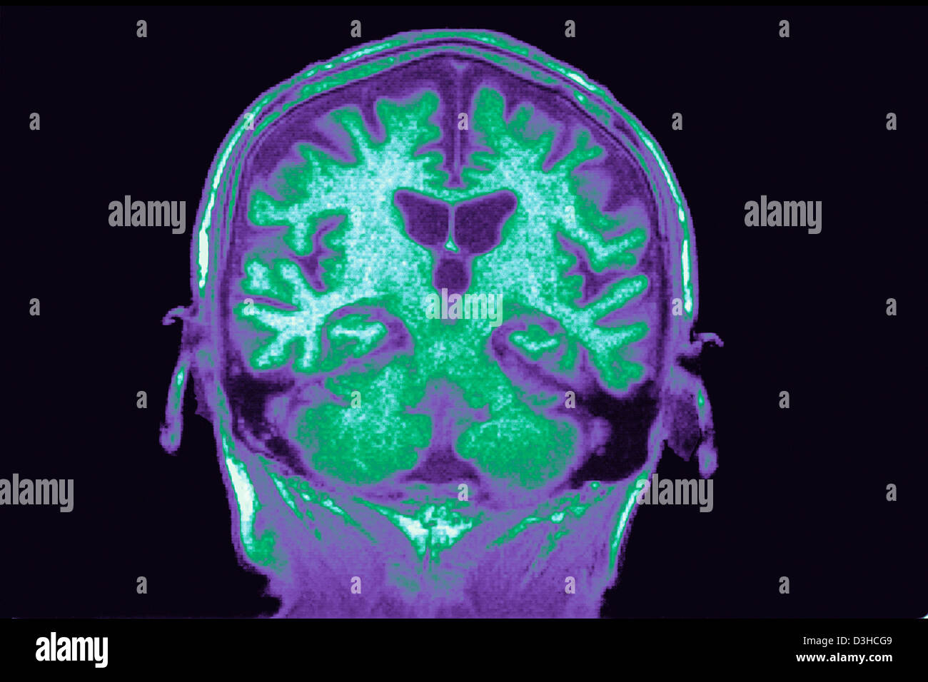 Mri brain scan normal hi-res stock photography and images - Alamy