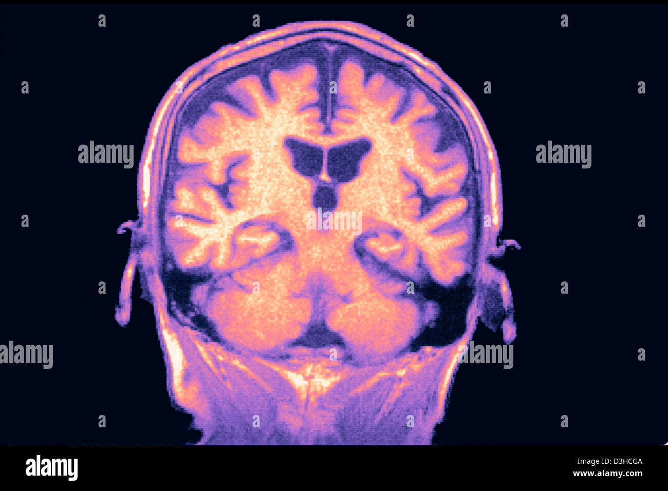 Nmr brain scan hi-res stock photography and images - Alamy