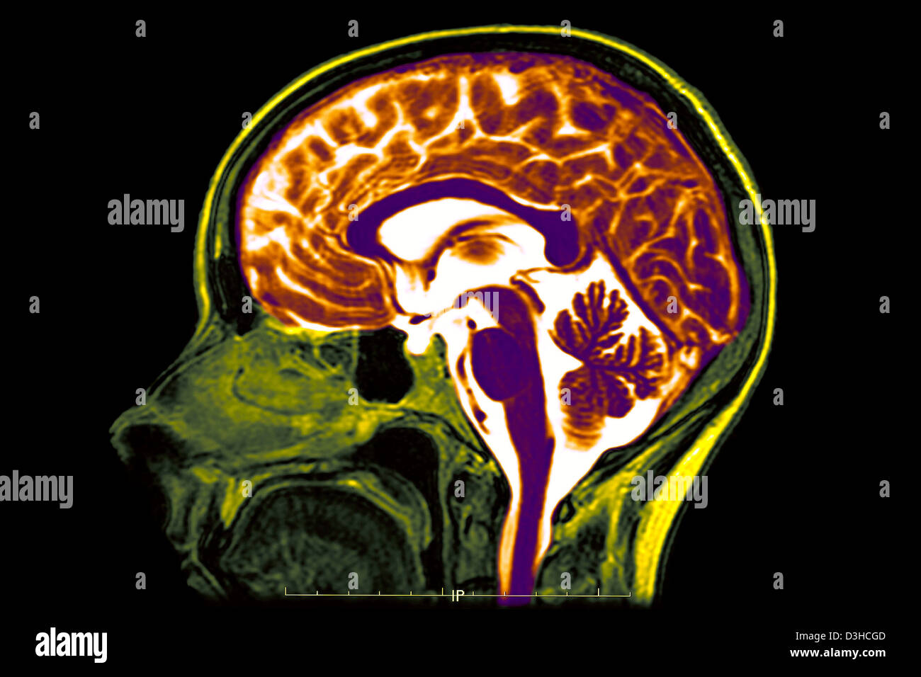 Cerebro mri hi-res stock photography and images - Alamy