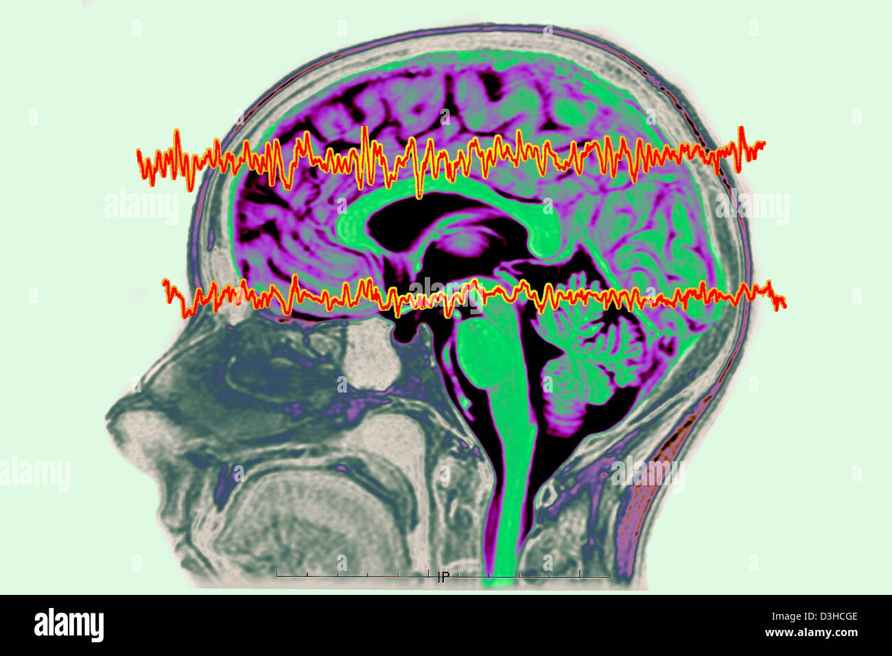Mri brain activity hi-res stock photography and images - Alamy