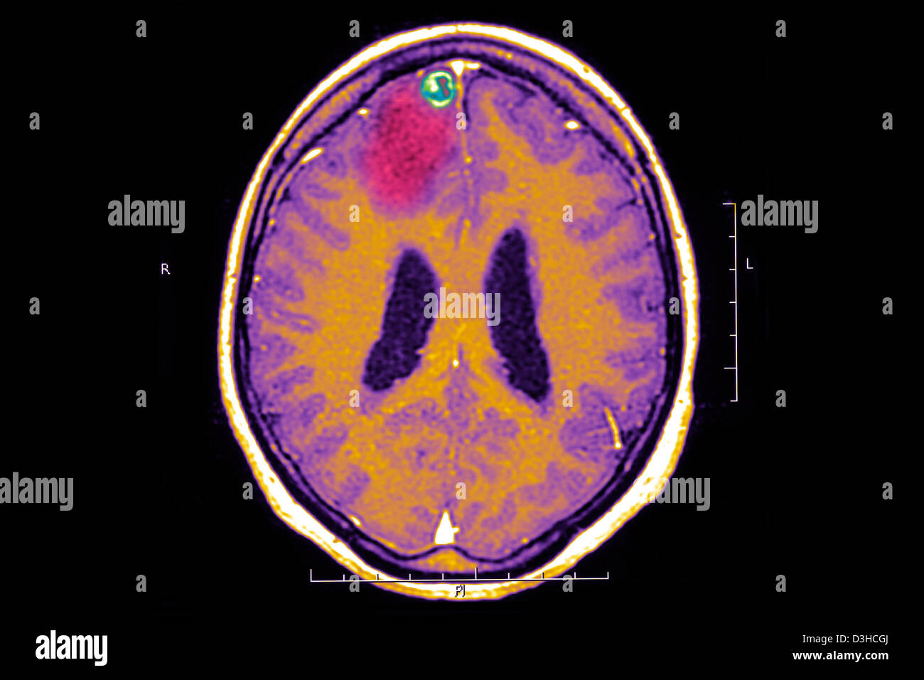 Epilepsy mri hi-res stock photography and images - Alamy