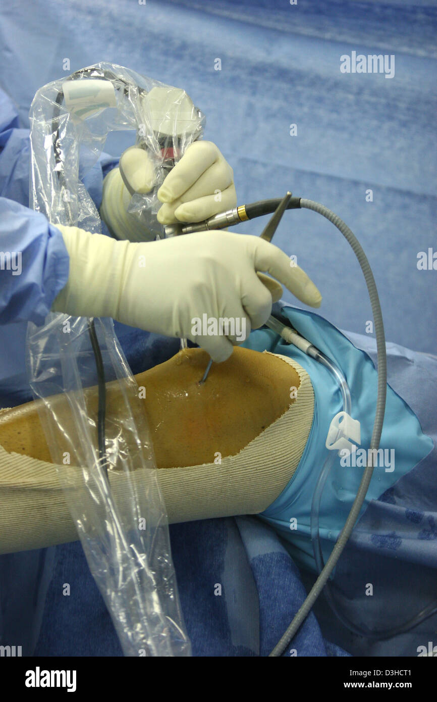 Knee arthroscopy hi-res stock photography and images - Alamy