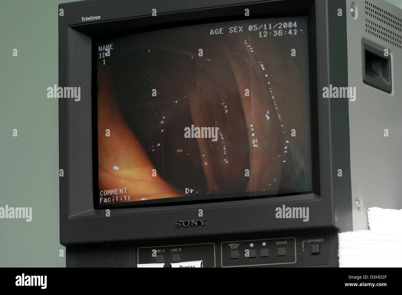 COLON, ENDOSCOPY EXAMINATION Stock Photo - Alamy