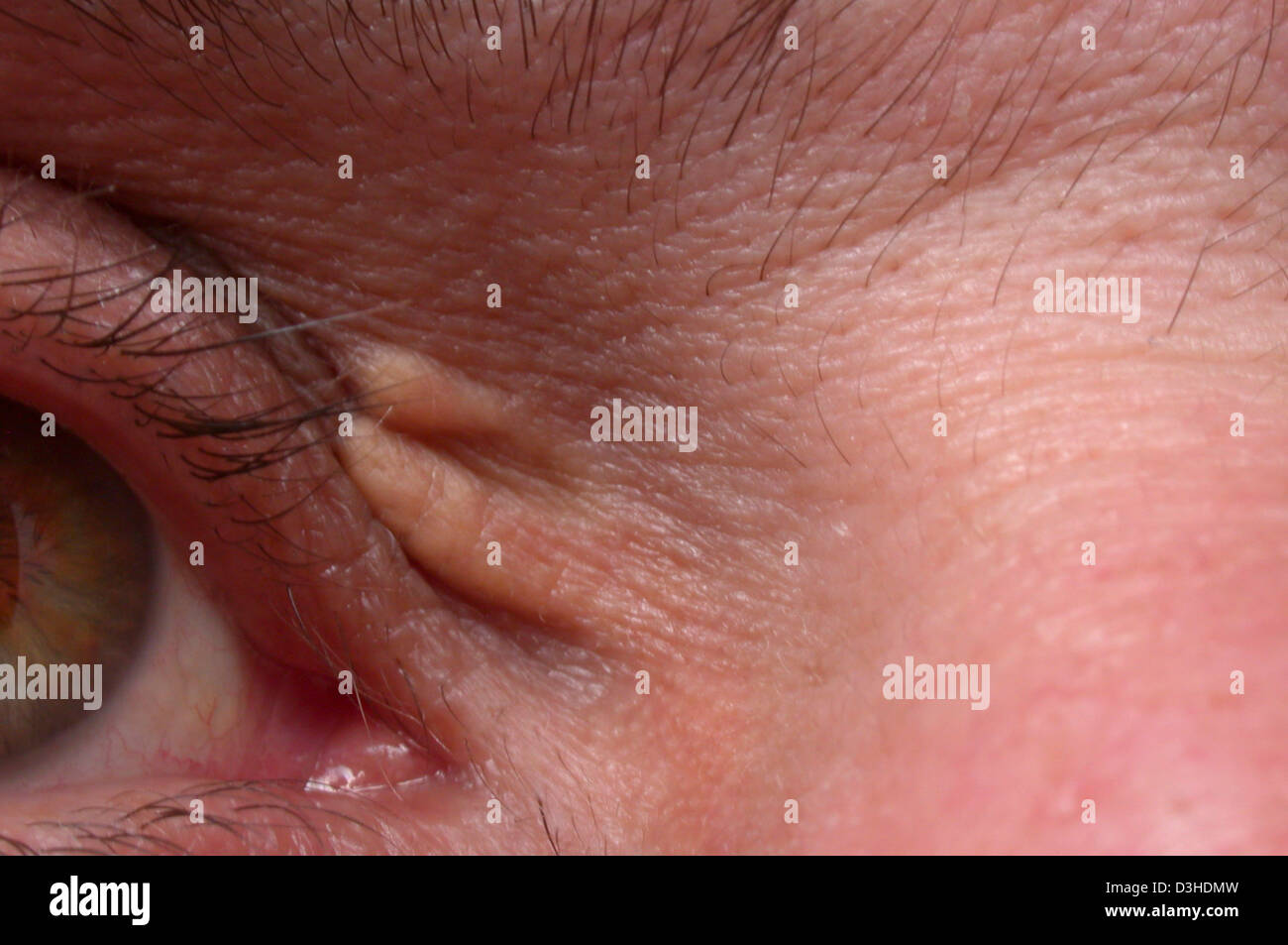 Xanthelasma hi-res stock photography and images - Alamy