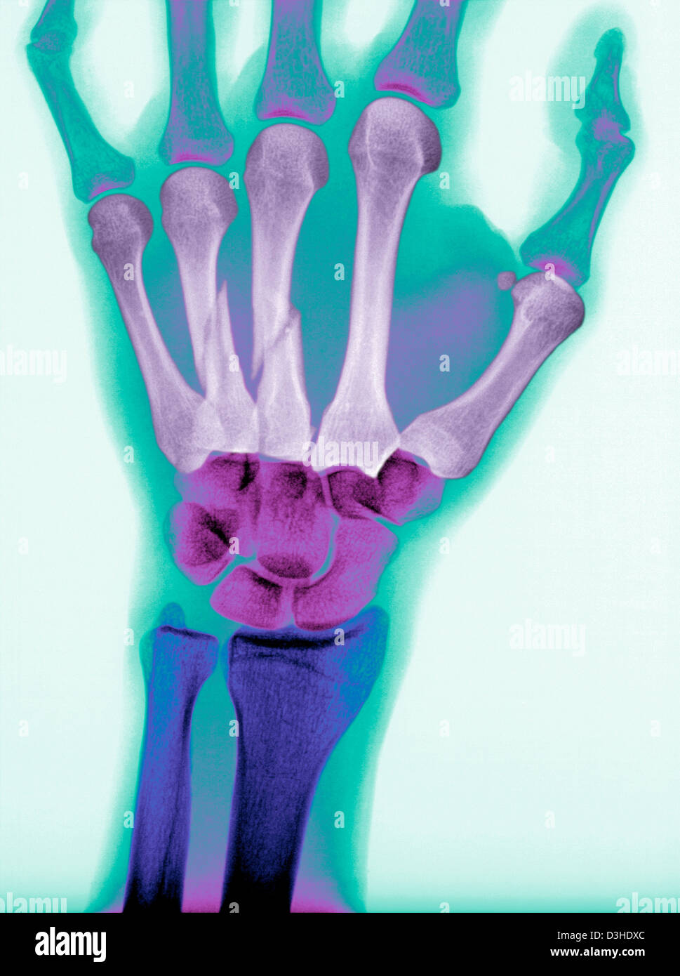 FRACTURED HAND, X-RAY Stock Photo - Alamy