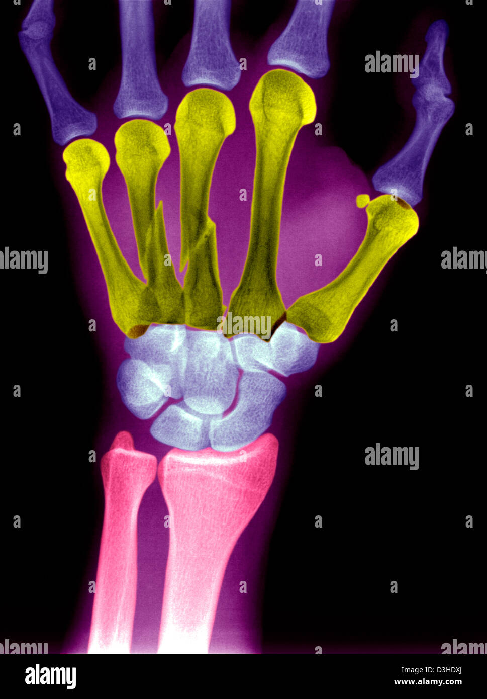 FRACTURED HAND, X-RAY Stock Photo - Alamy
