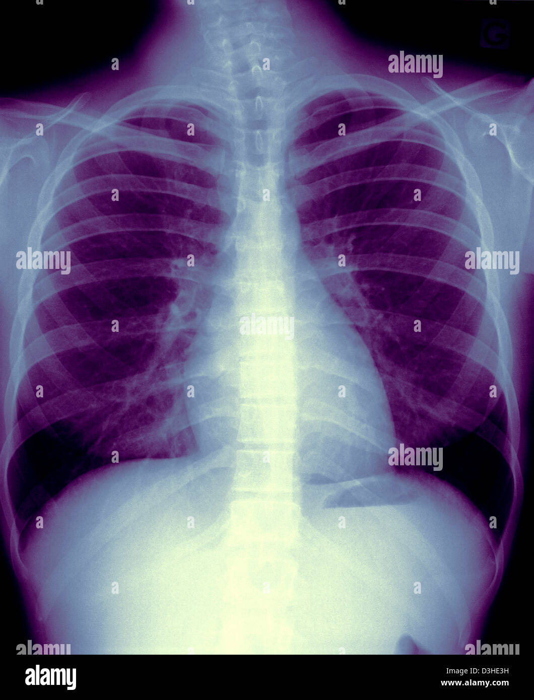 LUNG, X-RAY RESULT Stock Photo - Alamy