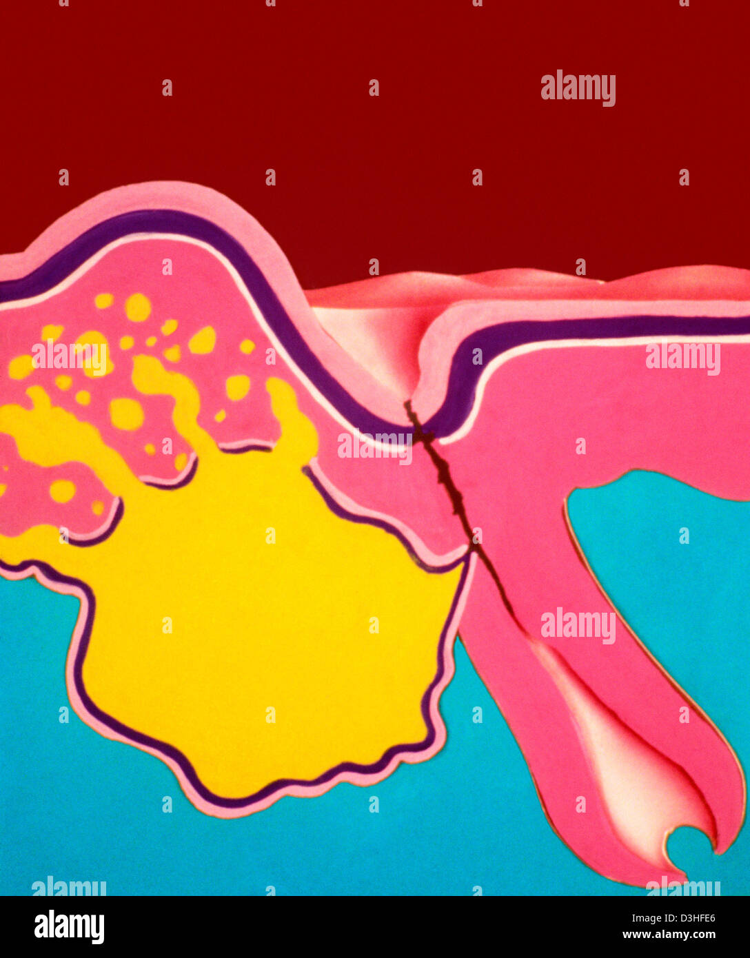 Acne drawing hi-res stock photography and images - Alamy